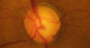 Glaucoma Care | Perlmutter Eye Center